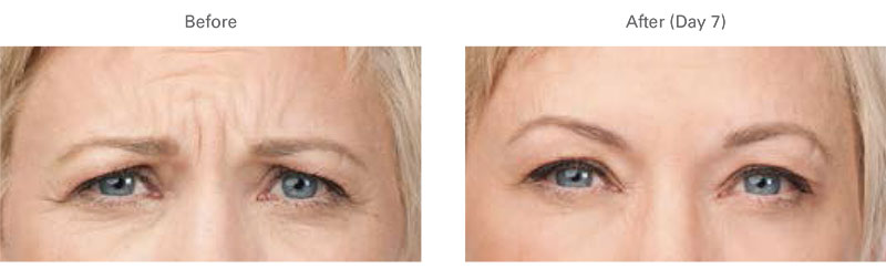 Botox - Injectables - Ark-La-Tex Dermatology - A Part of the Willis ...