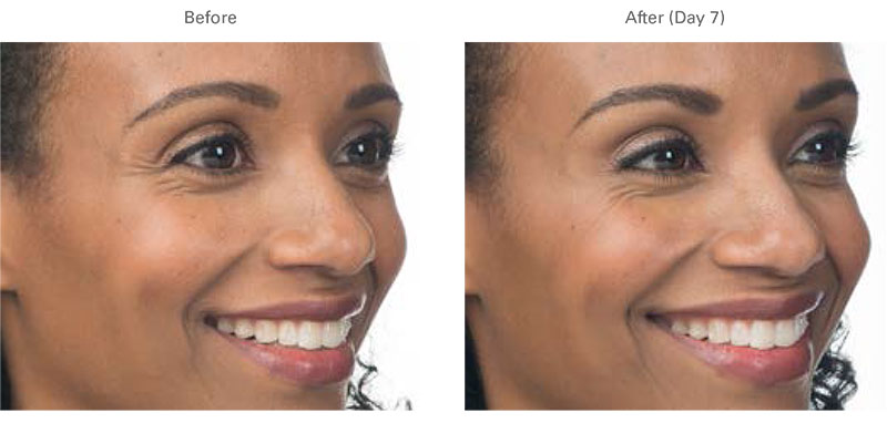 Before and After Photos - Botox - Ark-La-Tex Dermatology - A Part of ...